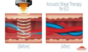 Acoustic Wave Therapy for Erectile Dysfunction | ED Treatment